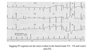 Drug and electrolytes effect on ECG | PPTX