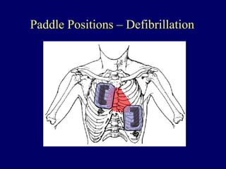 Defibrillation || DC (Dirrect Current) Shock | PPT