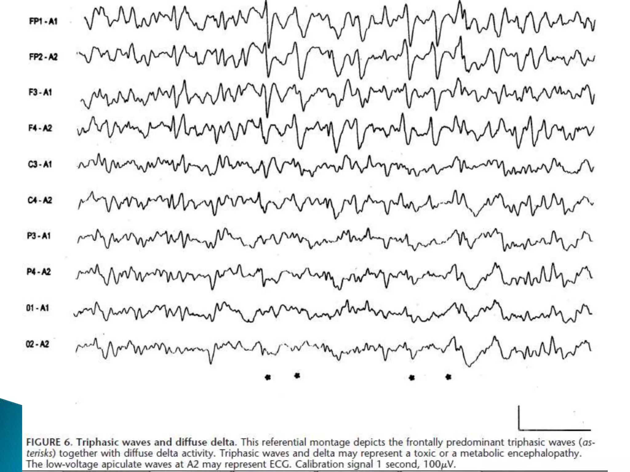 Drug Effects on EEG | PPTX