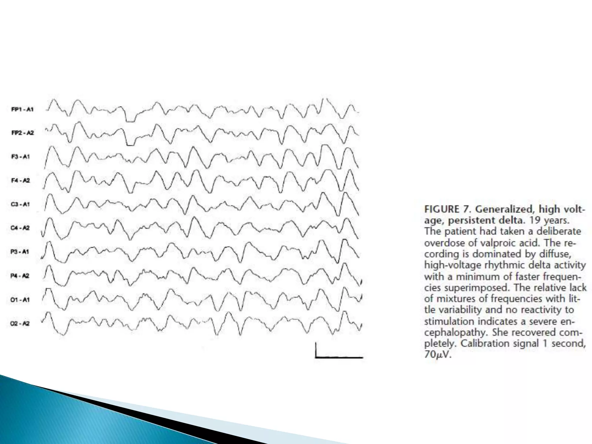 Drug Effects on EEG | PPTX