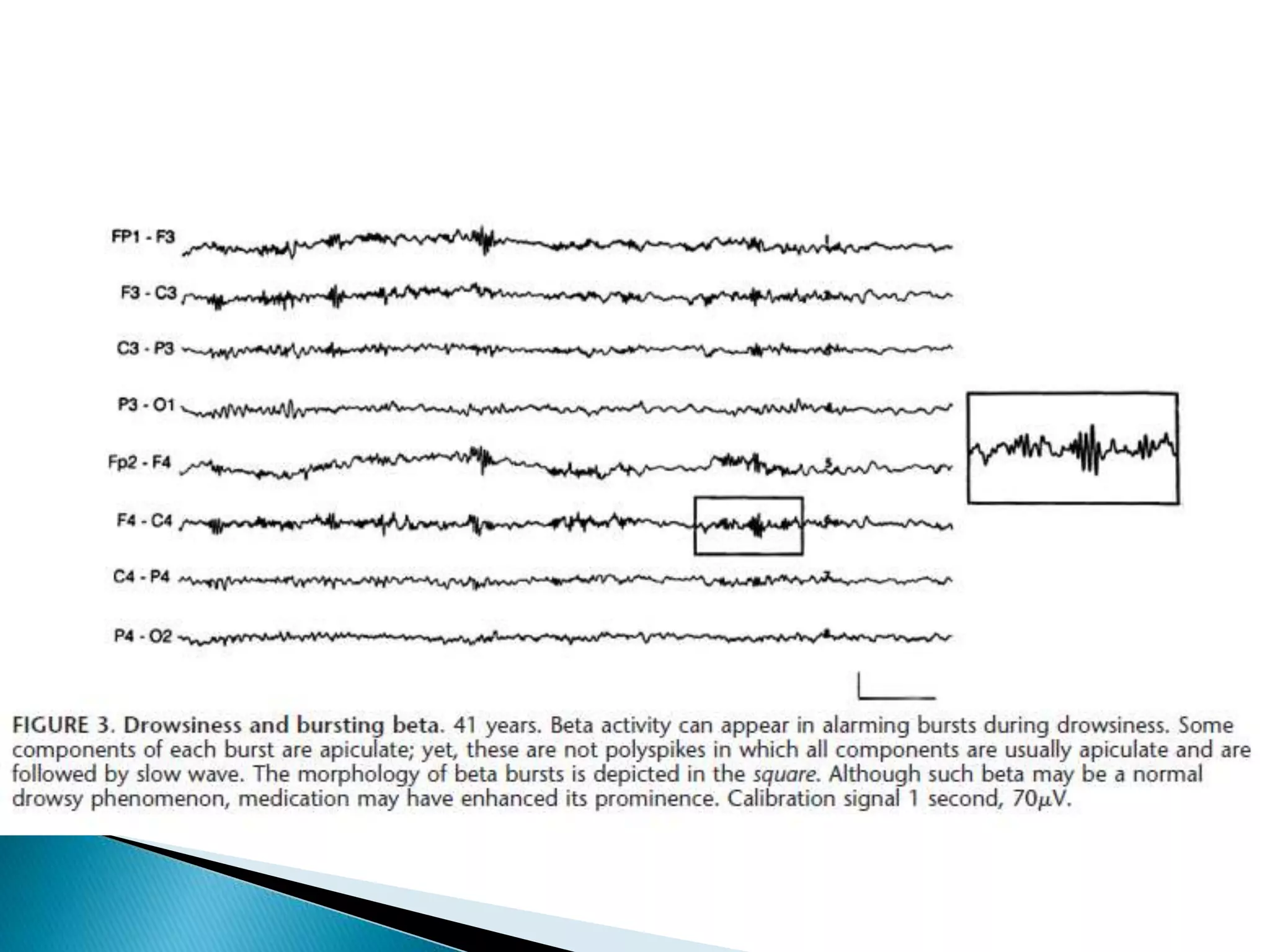 Drug Effects on EEG | PPTX