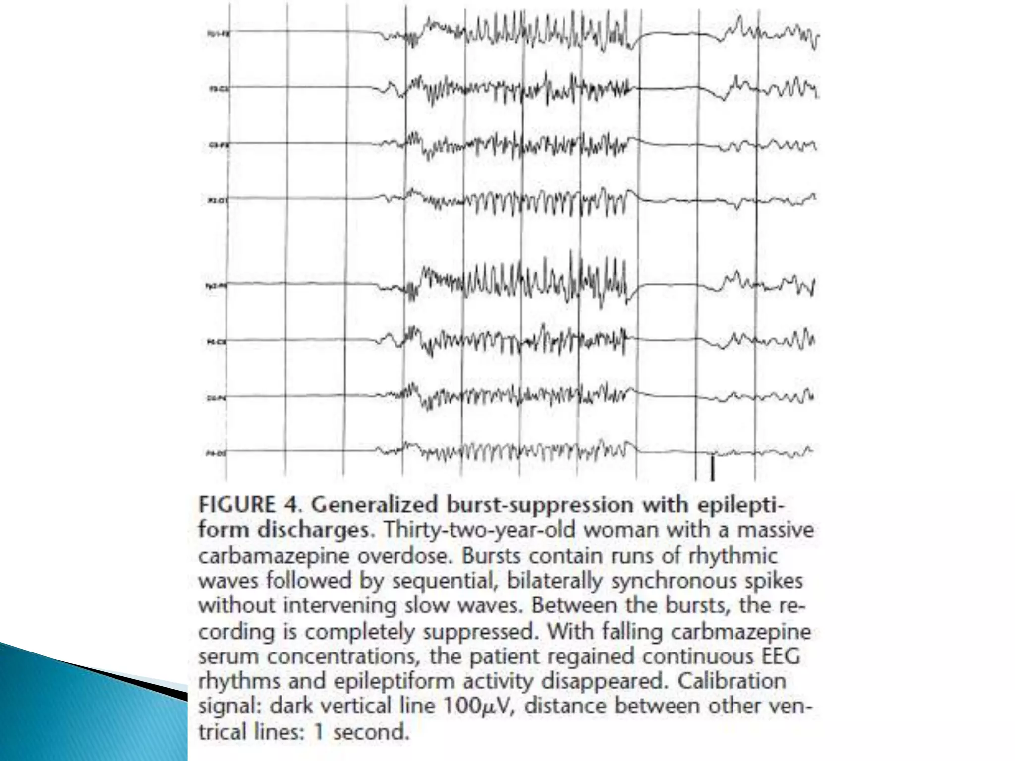 Drug Effects on EEG | PPTX