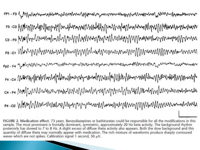 Drug Effects on EEG | PPTX | Illegal Drugs, Tobacco, eCigarettes ...