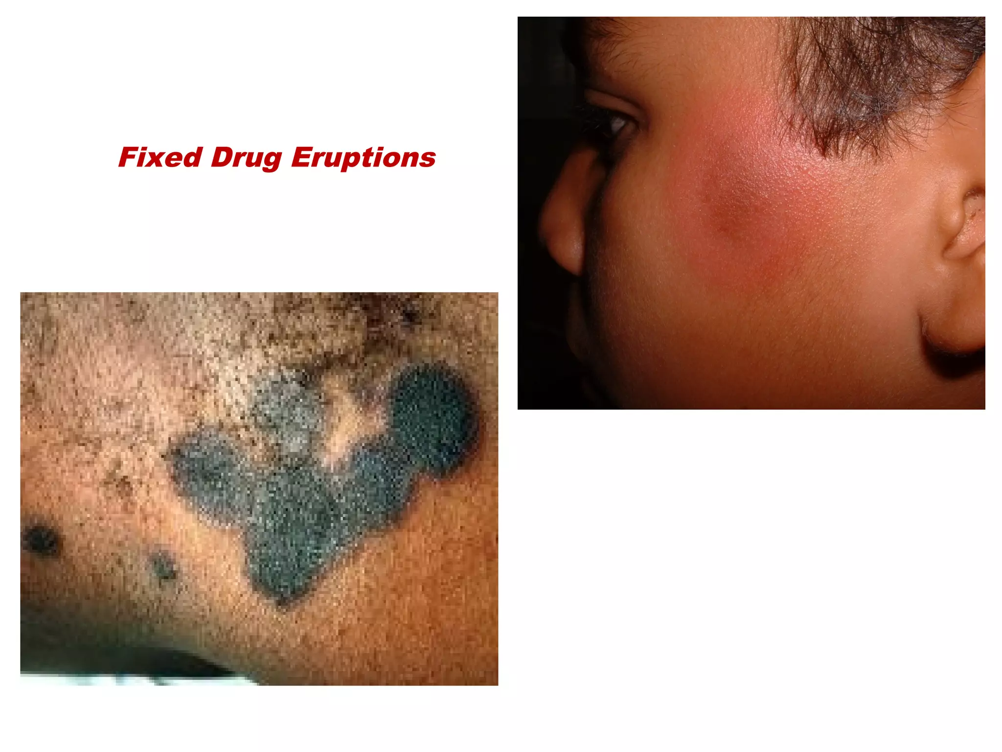 Drug eruptions | PPT