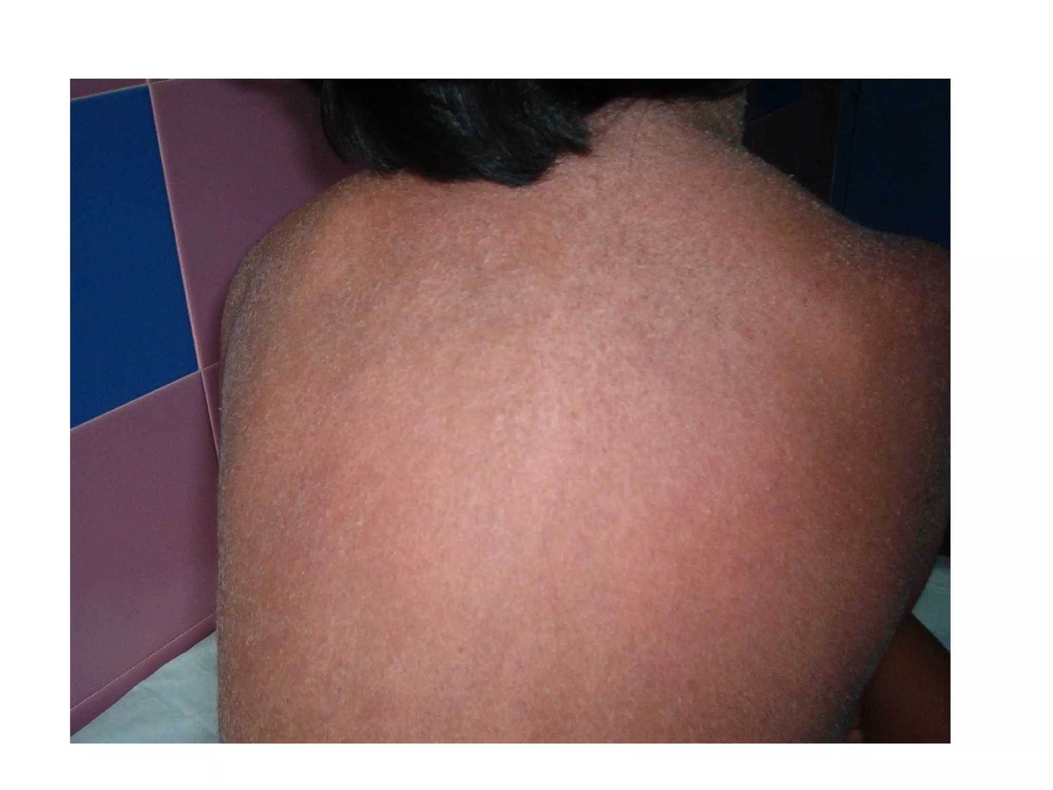 Drug eruptions | PPT