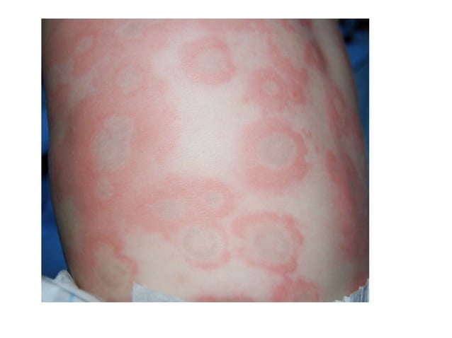 Drug eruptions | PPT