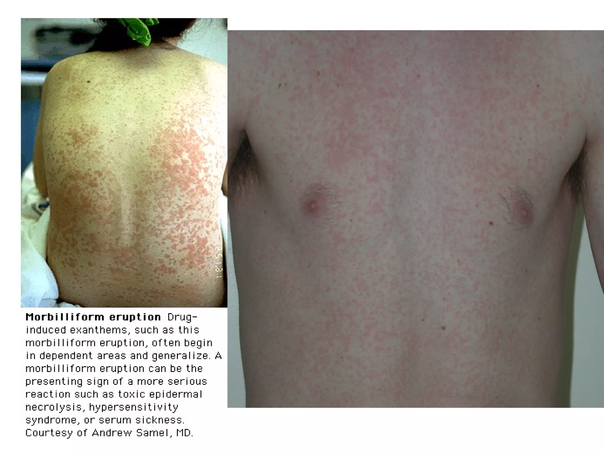 Drug eruptions | PPT | Allergies | Diseases and Conditions