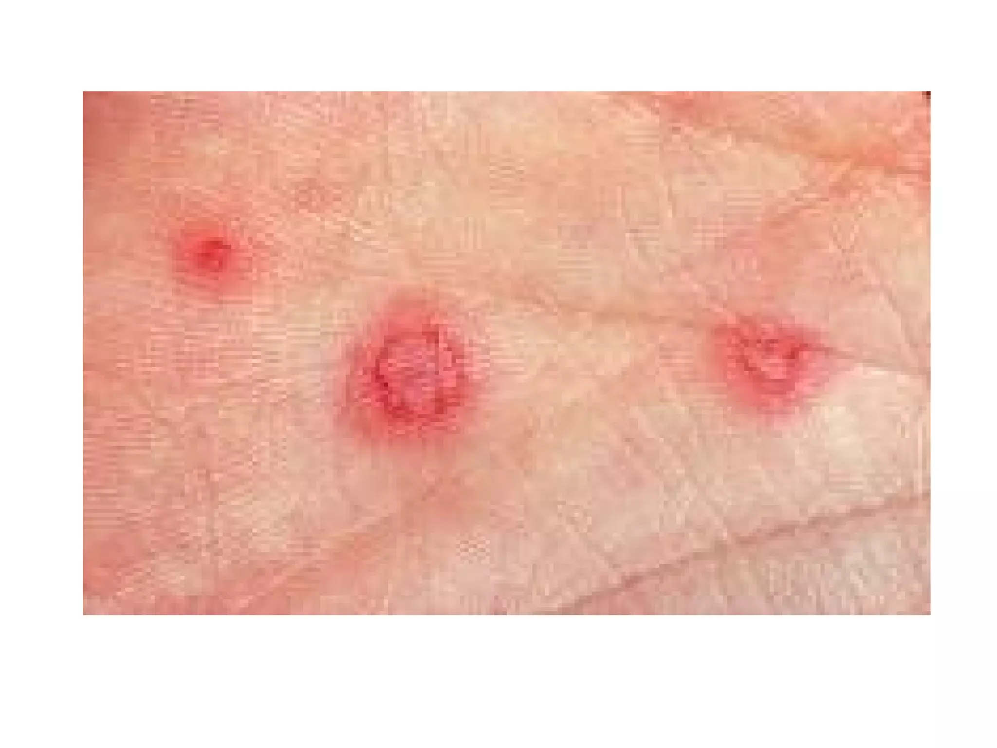 Drug eruptions | PPT