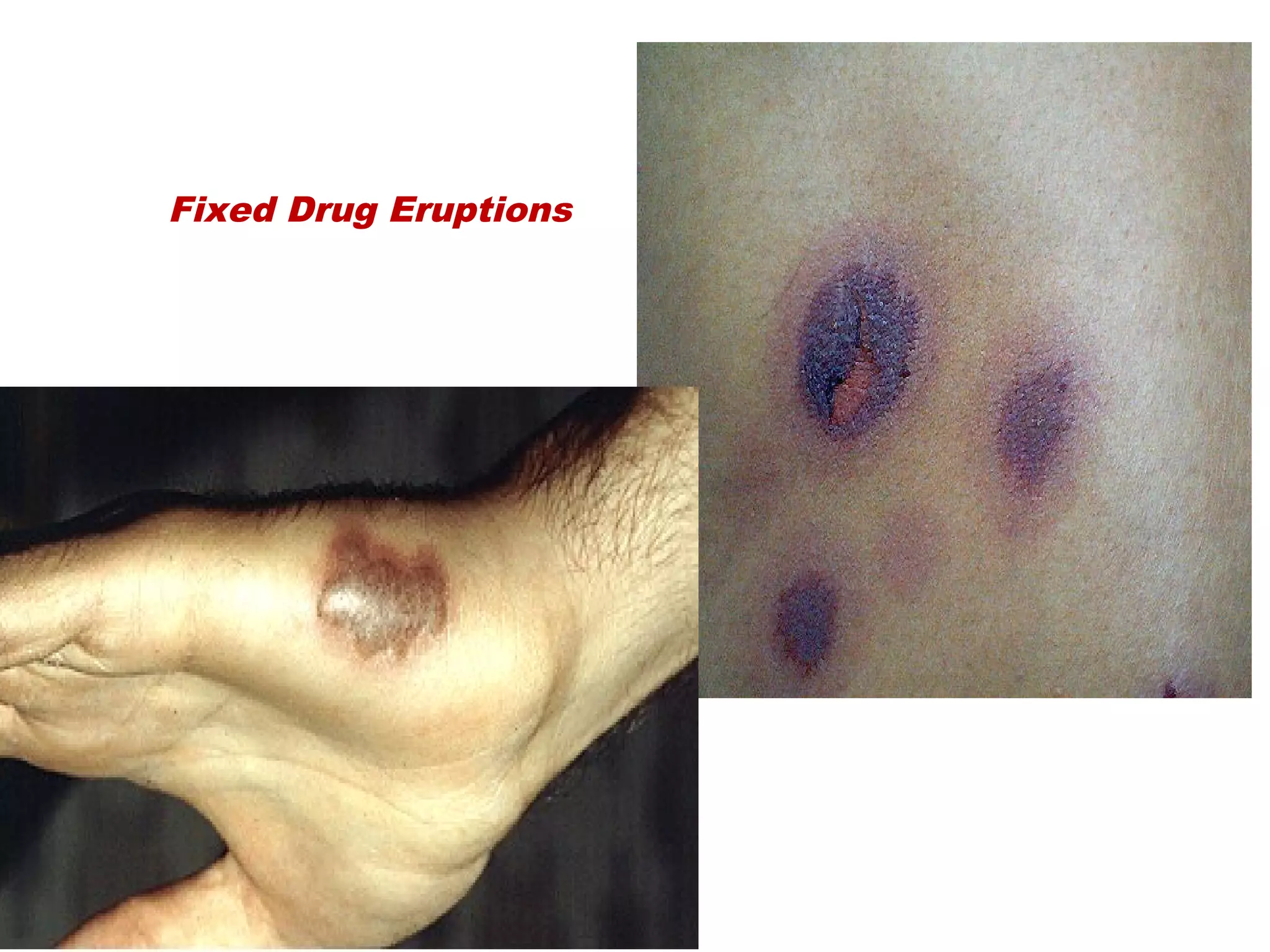 Drug eruptions | PPT