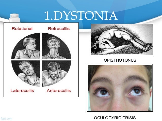 Drug induced movement disorders