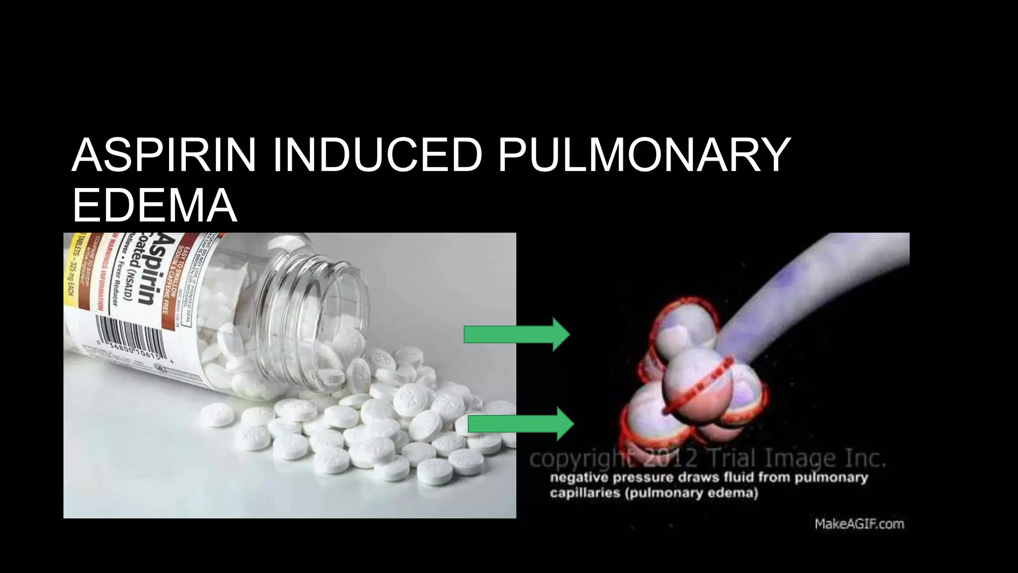 Drug induced pulmonary edema | PPTX