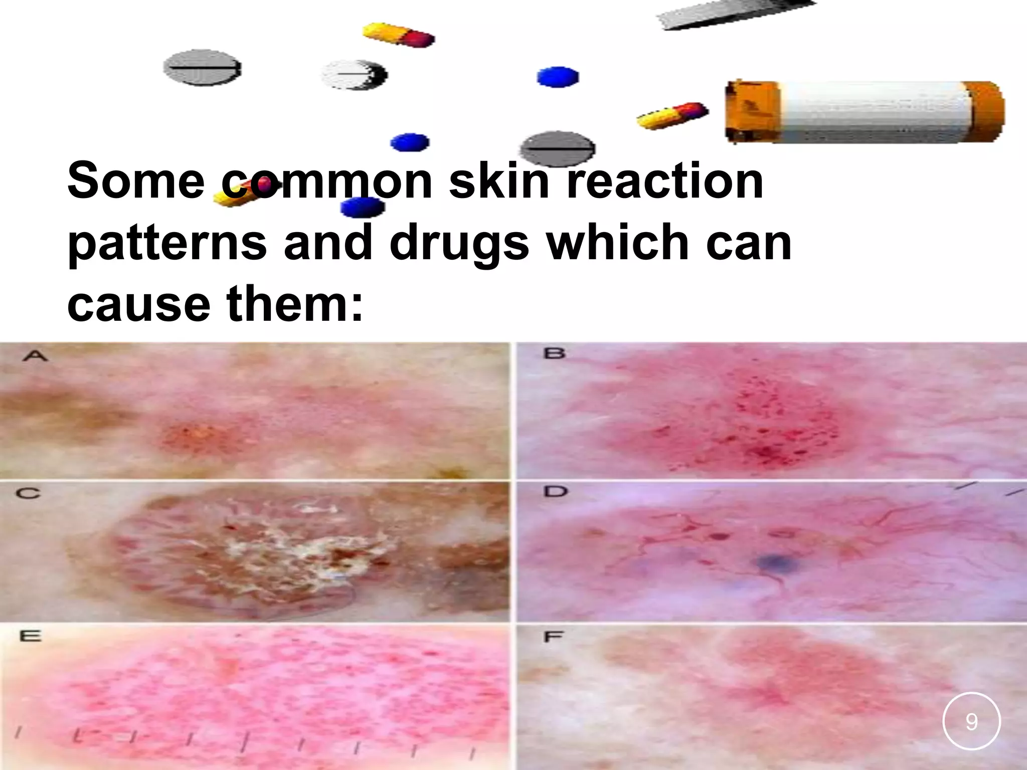 Drug Induced Skin Disorders | PPTX | Allergies | Diseases and Conditions
