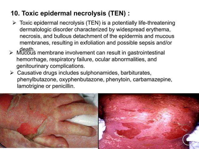 Drug Induced Skin Disorders