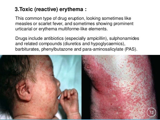 Drug Induced Skin Disorders