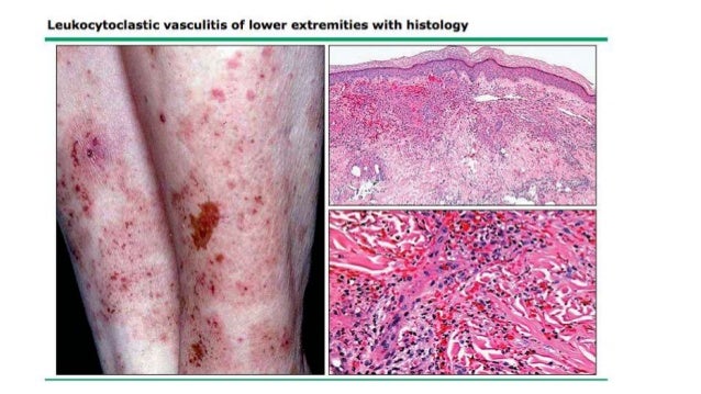 Drug induced skin emergencies