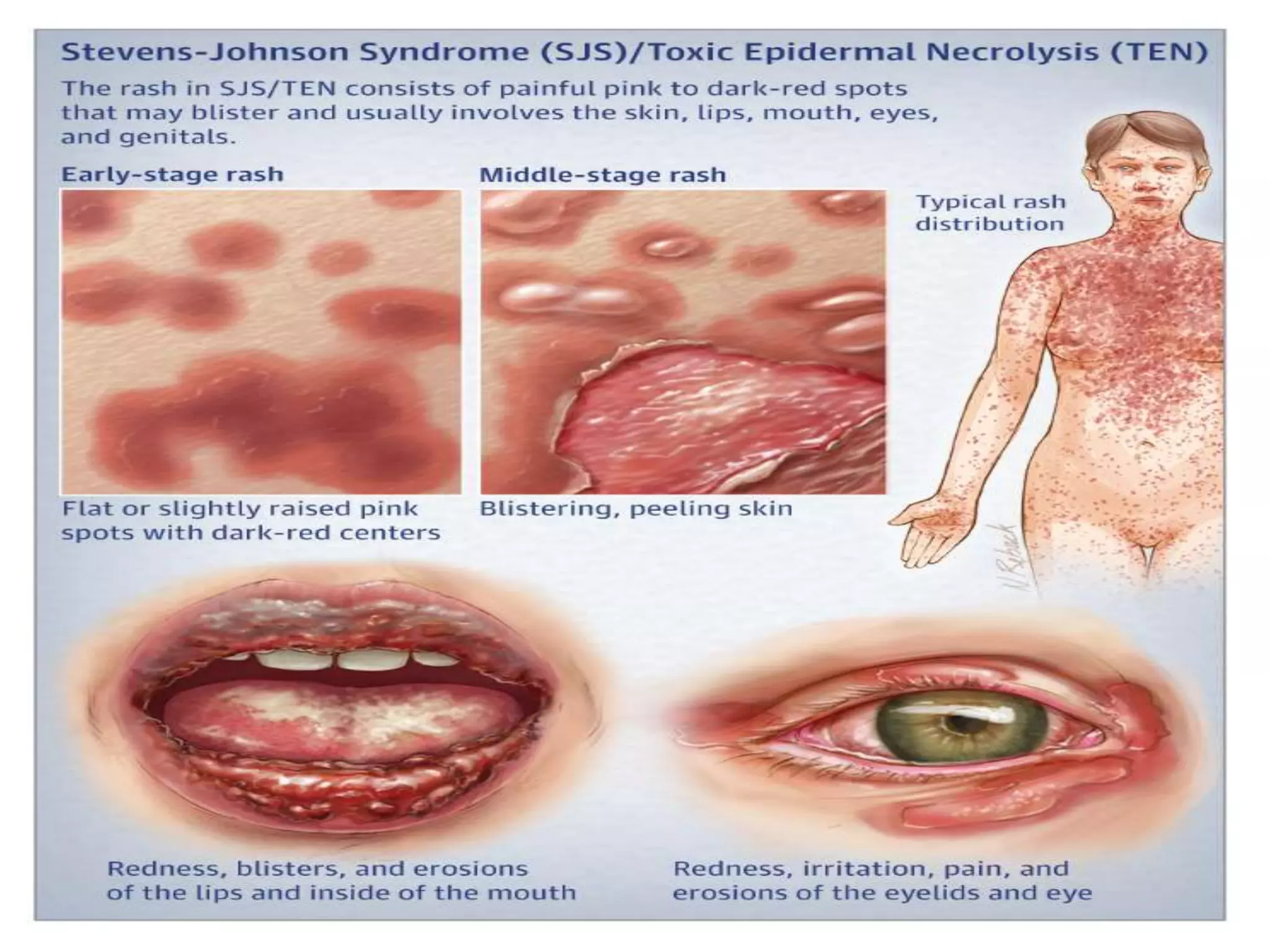 Drug induced steven johnson syndrome sjs | PPTX