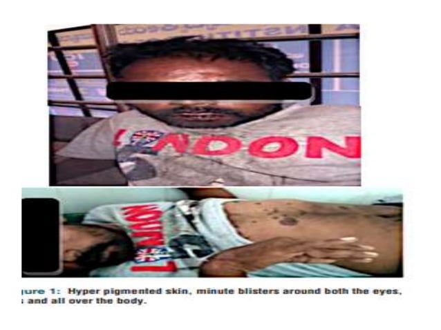 Drug induced steven johnson syndrome sjs | PPTX