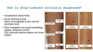 druginduced urticaria.pptx