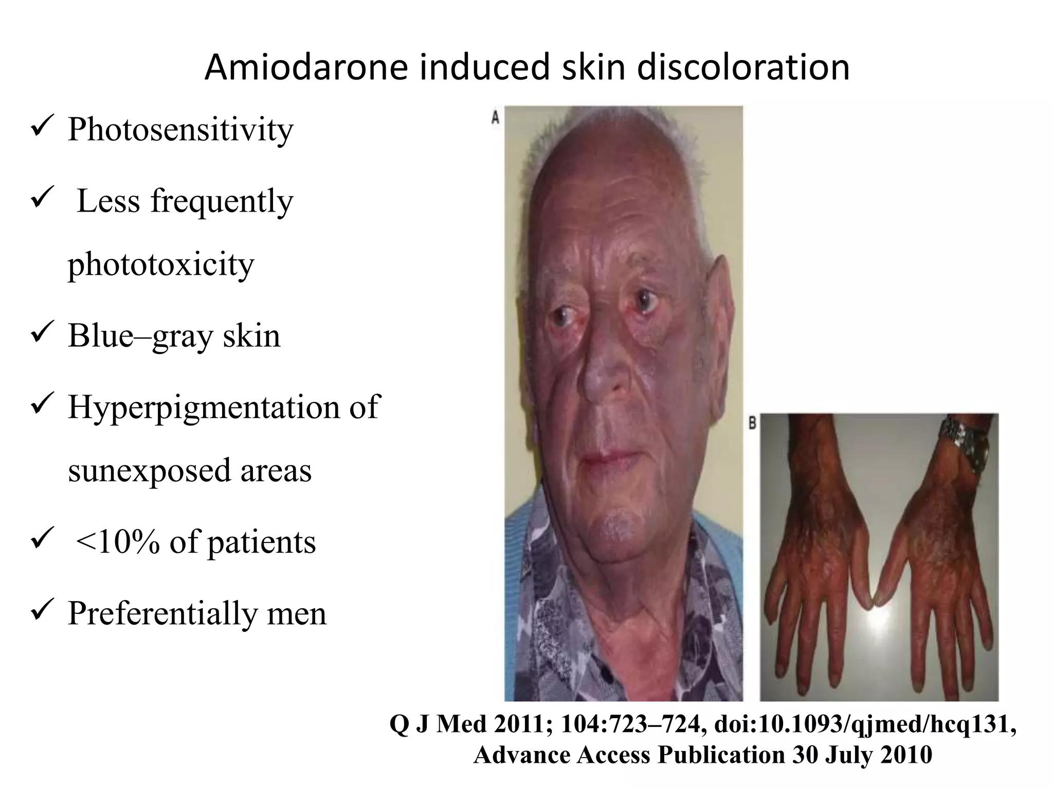 Amiodarone, Drug of the month | PPTX