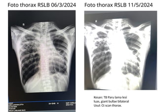 Drug Resistant Tuberculosis complicated with Pulmonary Hypertension ...