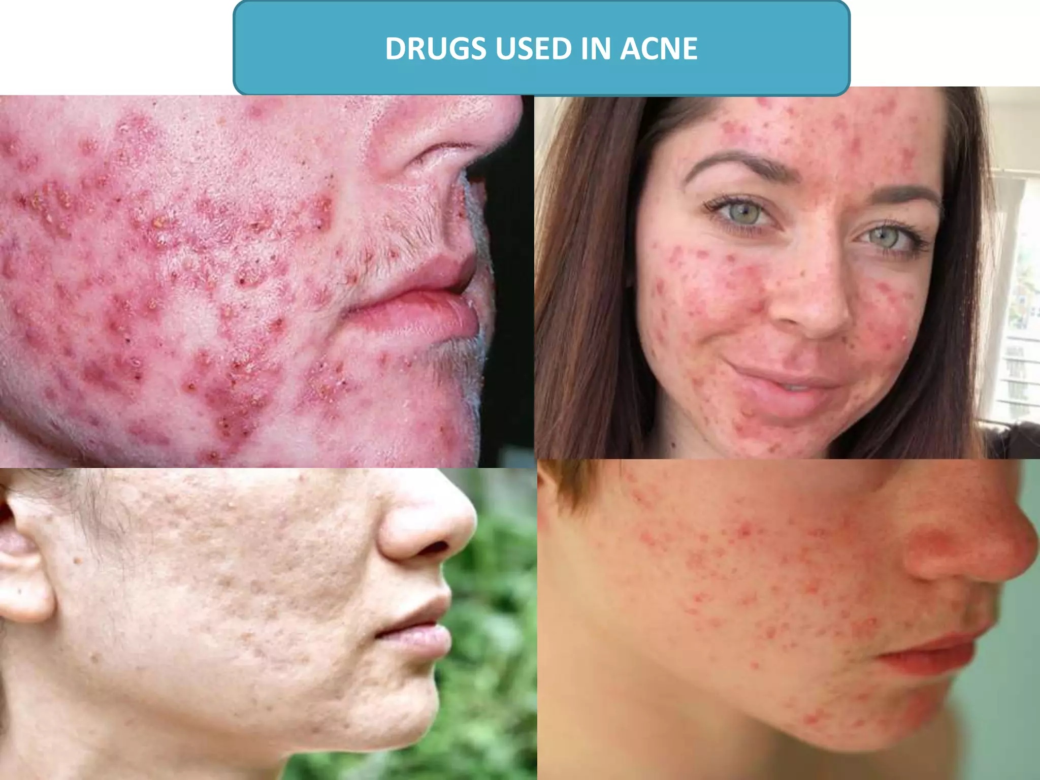 Drugs acting on skin- acne, psoriasis, sclerosing agents, melanizing ...
