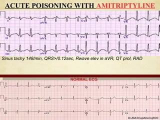Drugs altering ecg | PPT