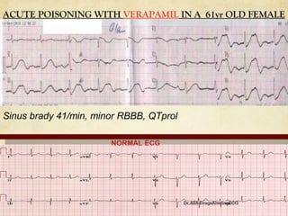 Drugs altering ecg | PPT