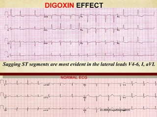 Drugs altering ecg | PPT