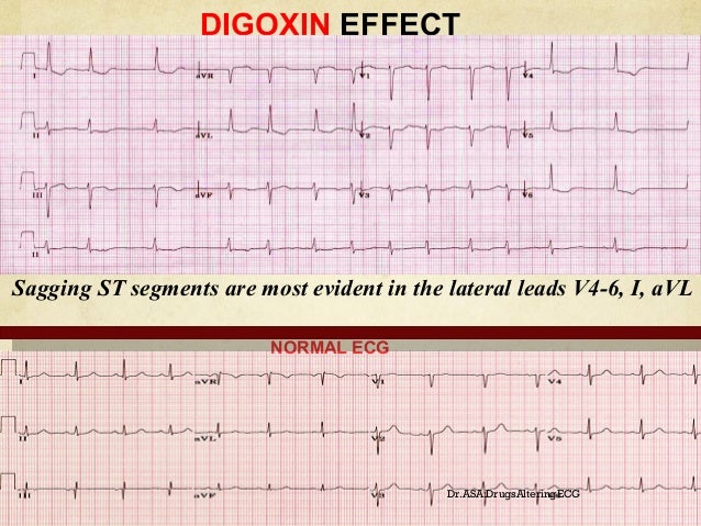 Drugs altering ecg