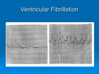 DRUGS AND DEFIBRILATION.ppt