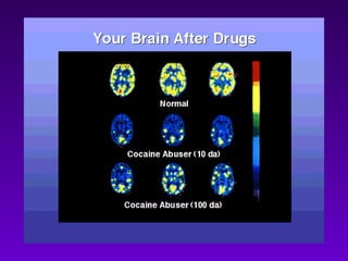 Drugsandthe Brain Part2 Addiction | PPT
