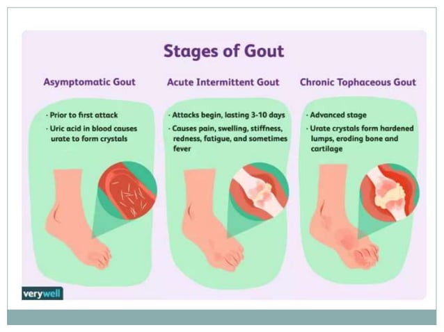 Drugs for Gout ( Acute and Chronic gout) | PPTX