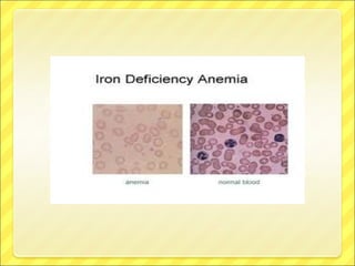 Drugs for iron def anemia | PPT