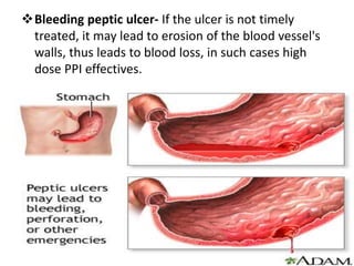 Drugs for peptic ulcer | PPTX