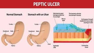 Drugs for Peptic Ulcer - Pathophysiology, Mechanism of action | PPTX