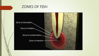 Drugs management in endodontic therapy | PPT