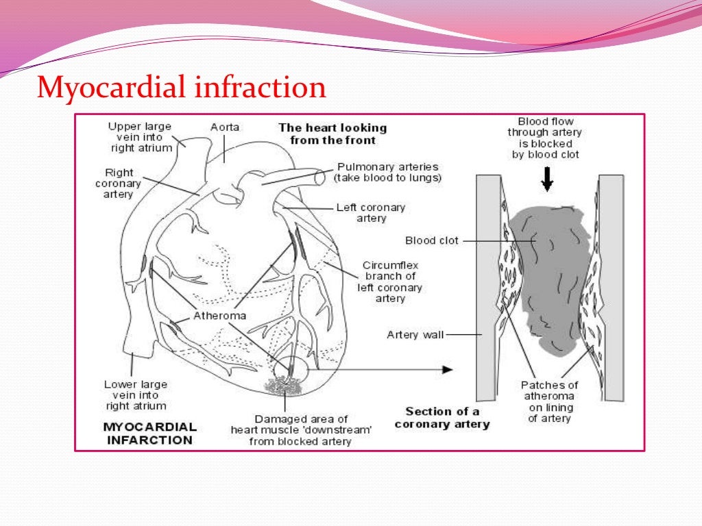 Drugs Used For The Treatment Of Myocardial Ischemia