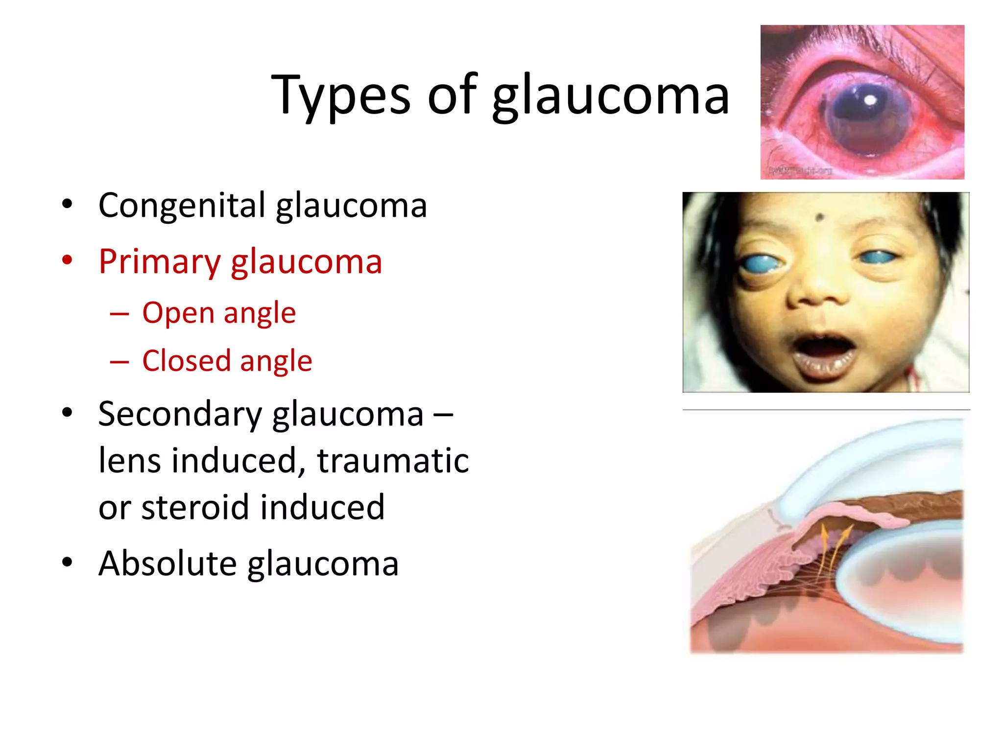 Drugs used in glaucoma | PPT