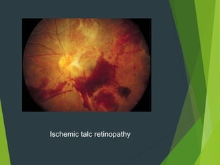 Talc Retinopathy