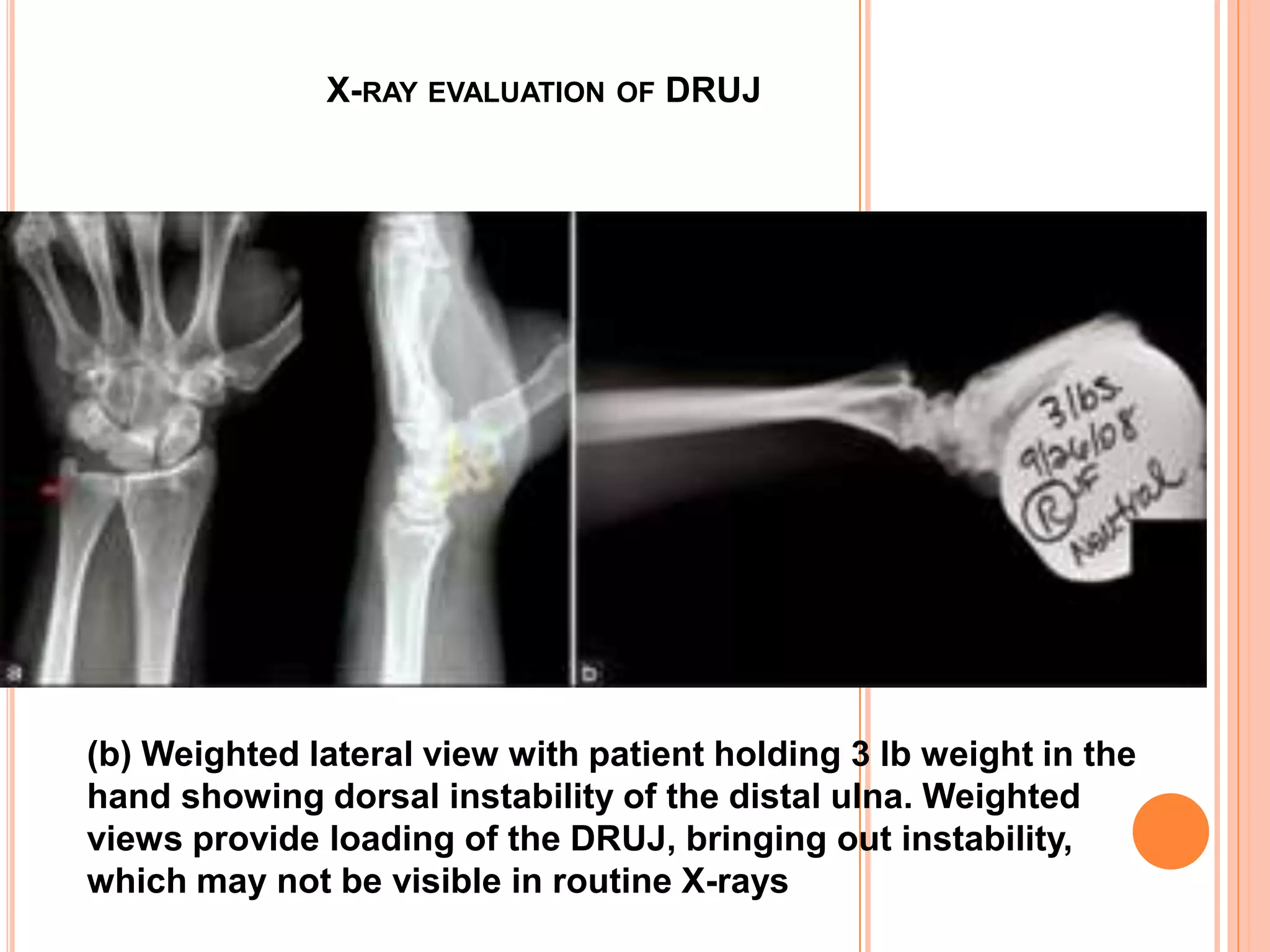 Druj and tfcc injuries f | PPTX