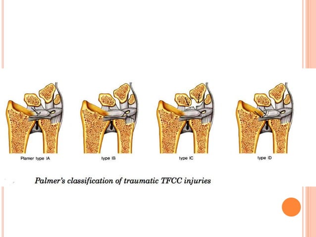 Druj and tfcc injuries f | PPT