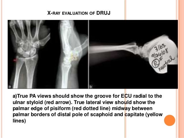 Druj and tfcc injuries f