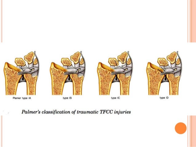 Druj and tfcc injuries f