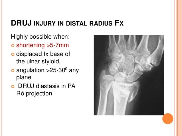 Druj and tfcc injuries f