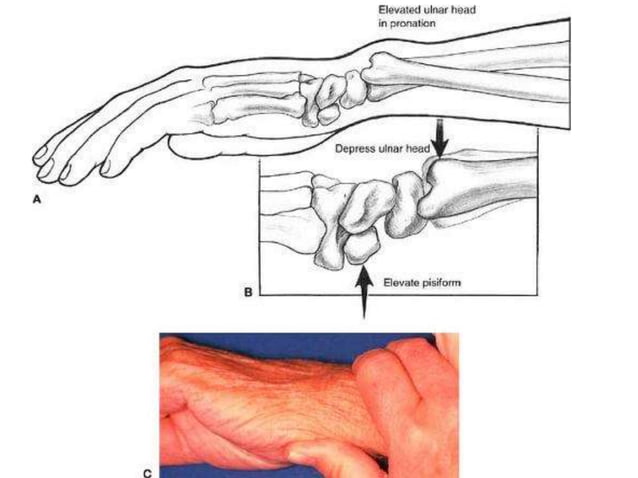 Distal Radioulnar Joint (DRUJ) Injuries | PPTX