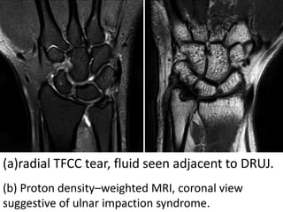 Distal Radioulnar Joint (DRUJ) Injuries | PPTX