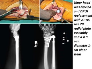 Distal Radioulnar Joint (DRUJ) Injuries | PPTX