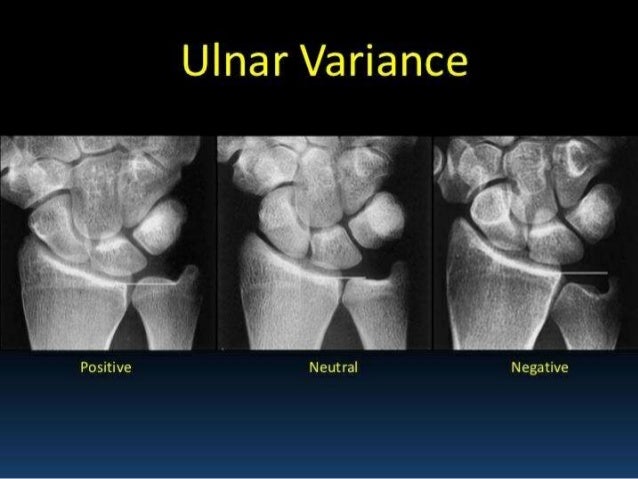 Distal Radioulnar Joint (DRUJ) Injuries