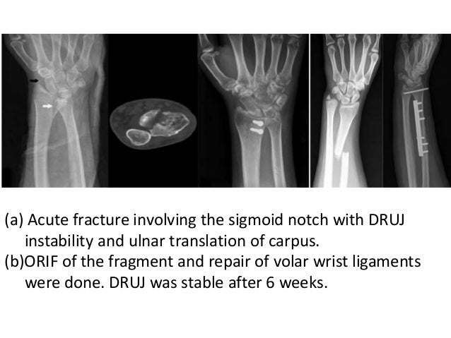 Distal Radioulnar Joint (DRUJ) Injuries