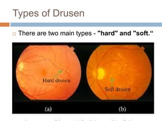 Drusen | PPTX | Eye and Vision Conditions | Diseases and Conditions